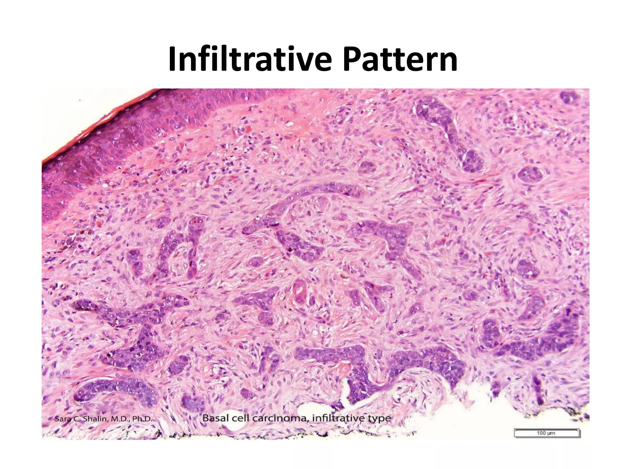Basal cell carcinoma | PPTX