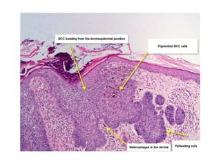 Basal cell carcinoma | PPTX