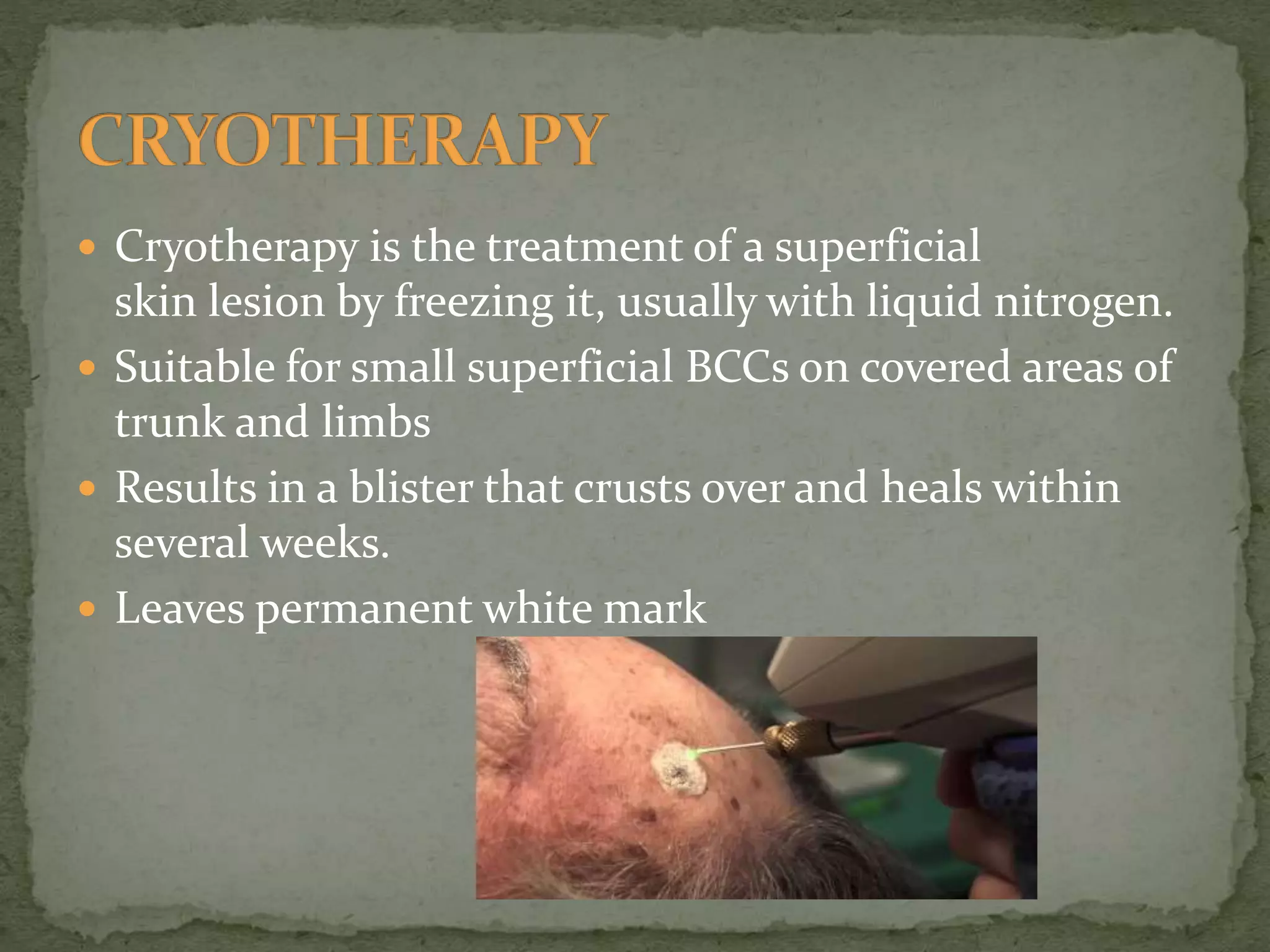 Basal cell carcinoma | PPTX