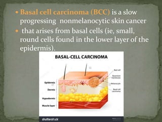 Basal cell carcinoma | PPTX
