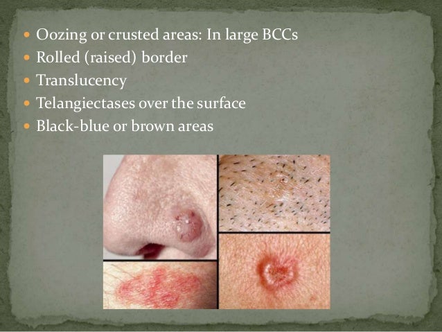 Basal cell carcinoma