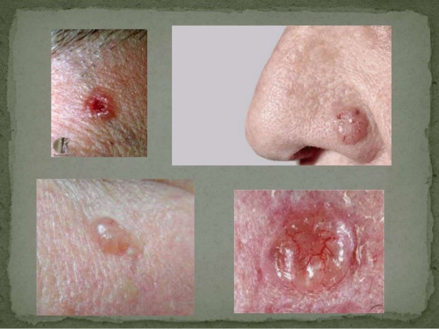 Basal cell carcinoma