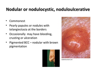 Basal Cell Carcinoma | PPT