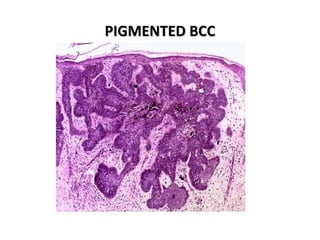 Basal Cell Carcinoma | PPT