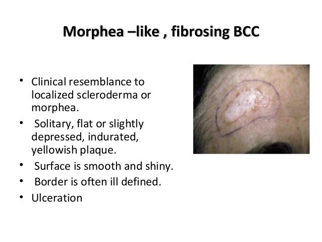 Basal Cell Carcinoma