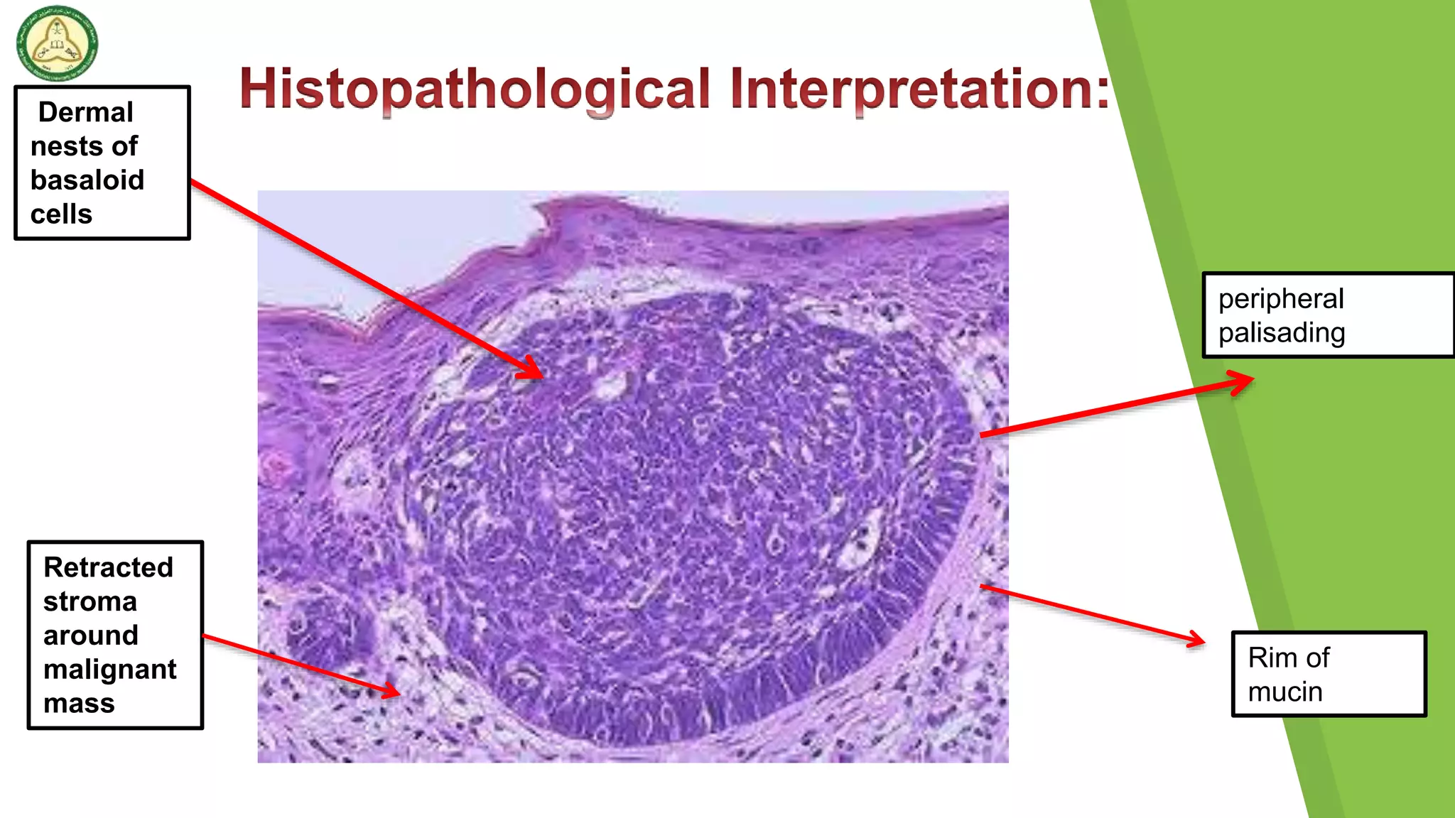 Basal cell carcinoma | PPTX