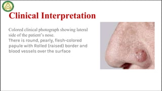 Basal cell carcinoma | PPTX