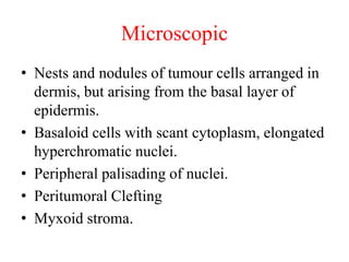 Basal cell carcinoma | PPTX