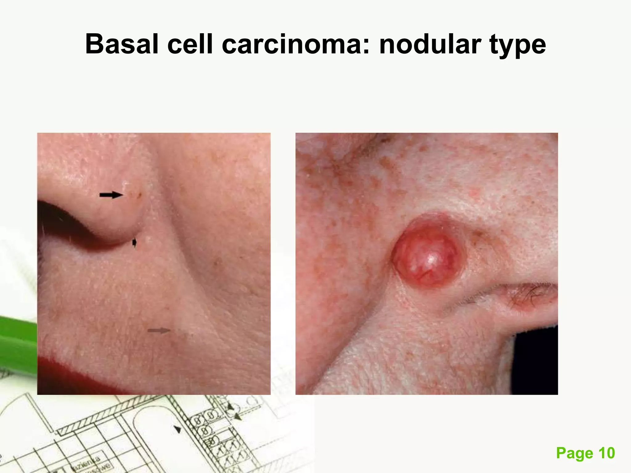Basal cell carcinoma (BCC) | PPT