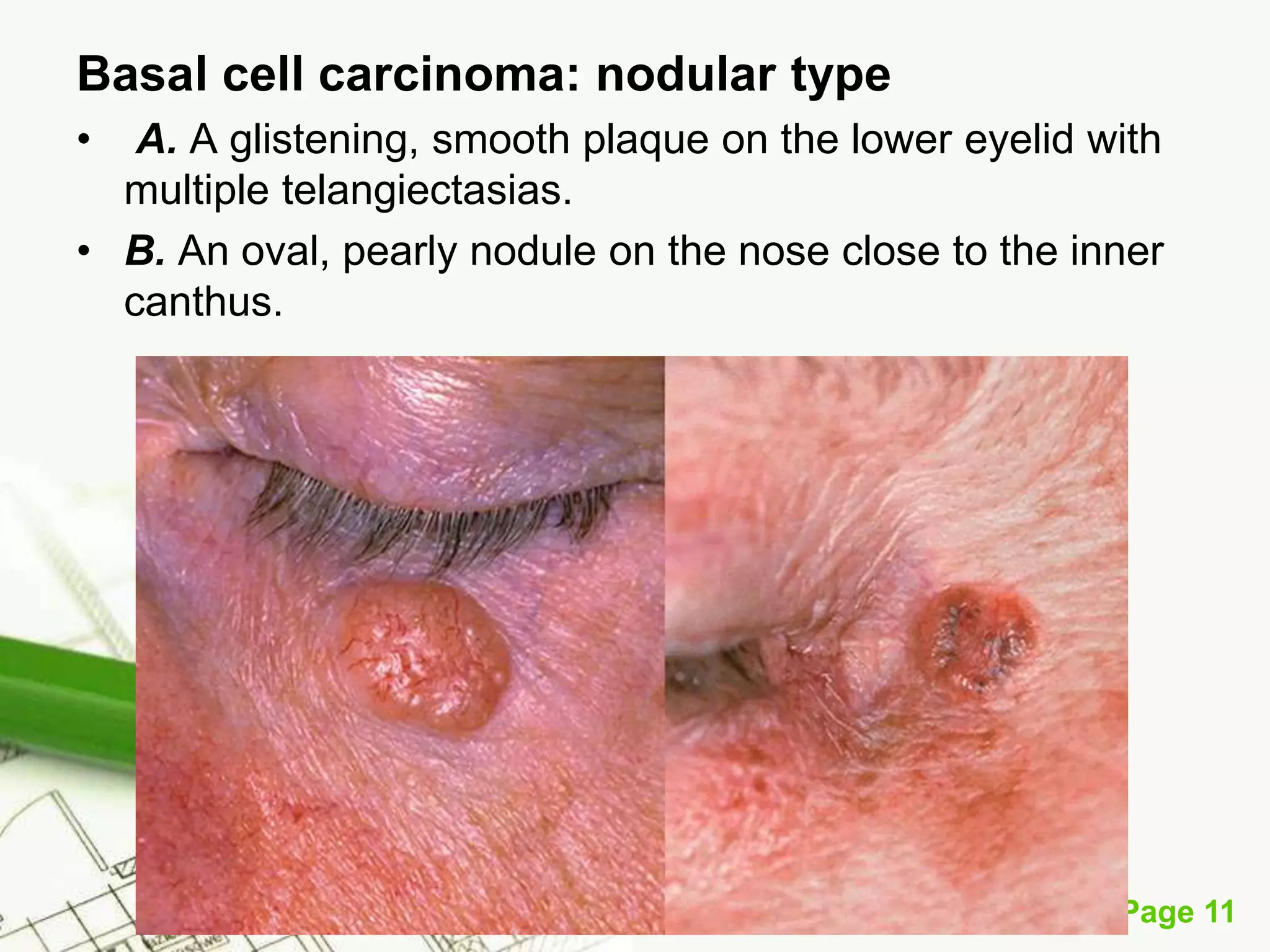 Basal cell carcinoma (BCC) | PPT