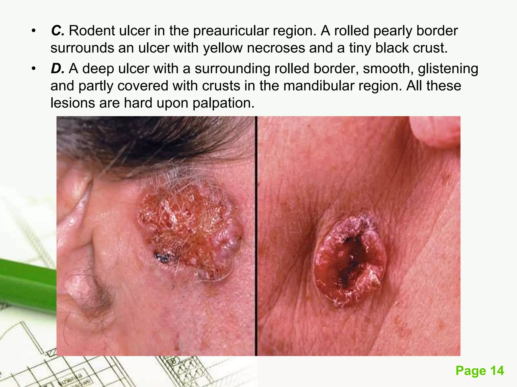 Basal cell carcinoma (BCC) | PPT