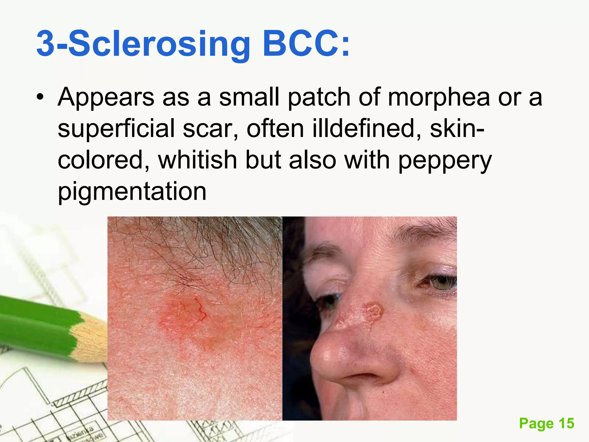 Basal cell carcinoma (BCC) | PPT