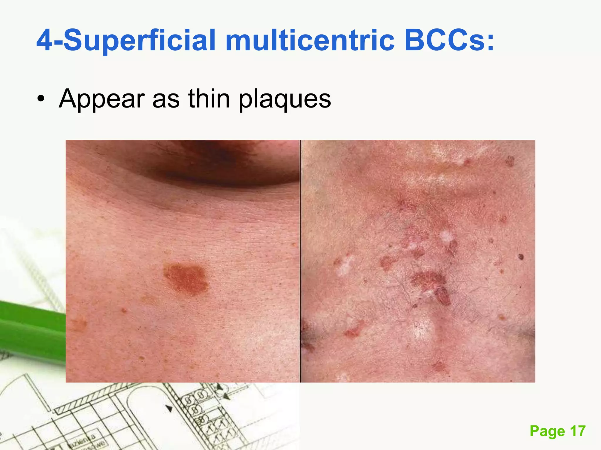 Basal cell carcinoma (BCC) | PPT | Skin and Dermatology | Diseases and ...