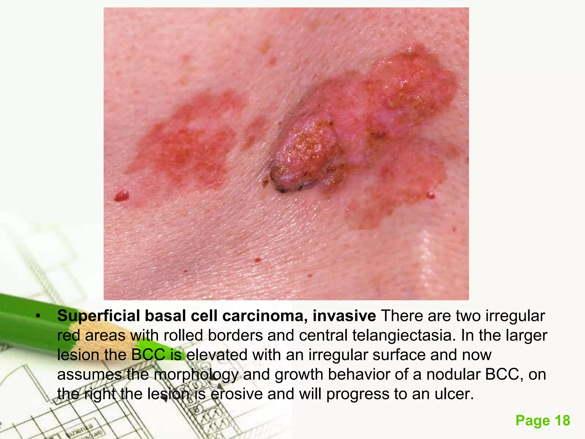 Basal cell carcinoma (BCC) | PPT