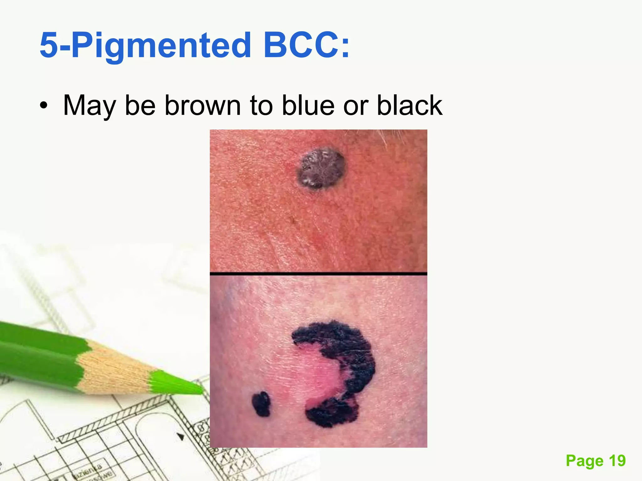 Basal cell carcinoma (BCC) | PPT