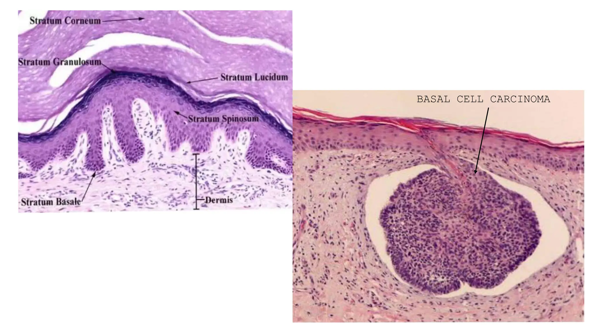 Skin Cancer- Basal Cell Carcinoma Most Common | PPTX