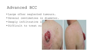 Skin Cancer- Basal Cell Carcinoma Most Common | PPTX