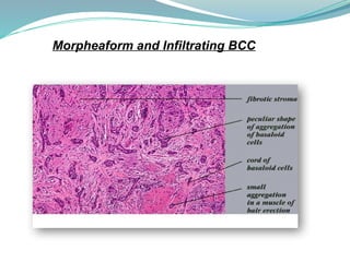 BASAL_CELL_CARCINOMA basal cell carcinoma sunlight exposure.pptx