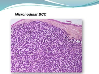 BASAL_CELL_CARCINOMA basal cell carcinoma sunlight exposure.pptx