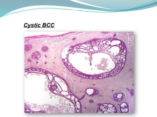 BASAL_CELL_CARCINOMA basal cell carcinoma sunlight exposure.pptx