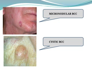 BASAL_CELL_CARCINOMA basal cell carcinoma sunlight exposure.pptx