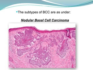 BASAL_CELL_CARCINOMA basal cell carcinoma sunlight exposure.pptx
