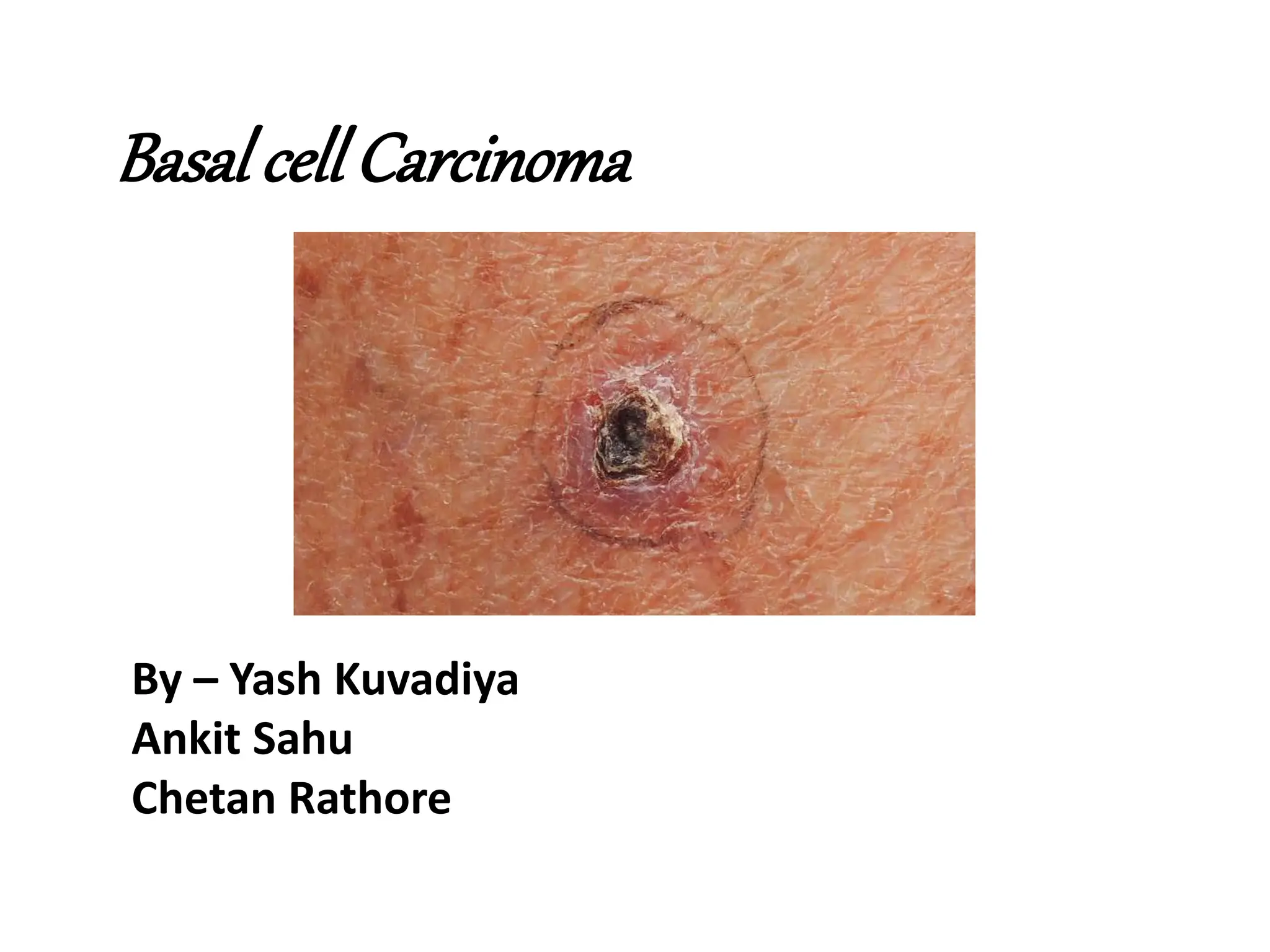 basal cell carcinoma 1807 cancer tumor marker tnm classification | PPTX