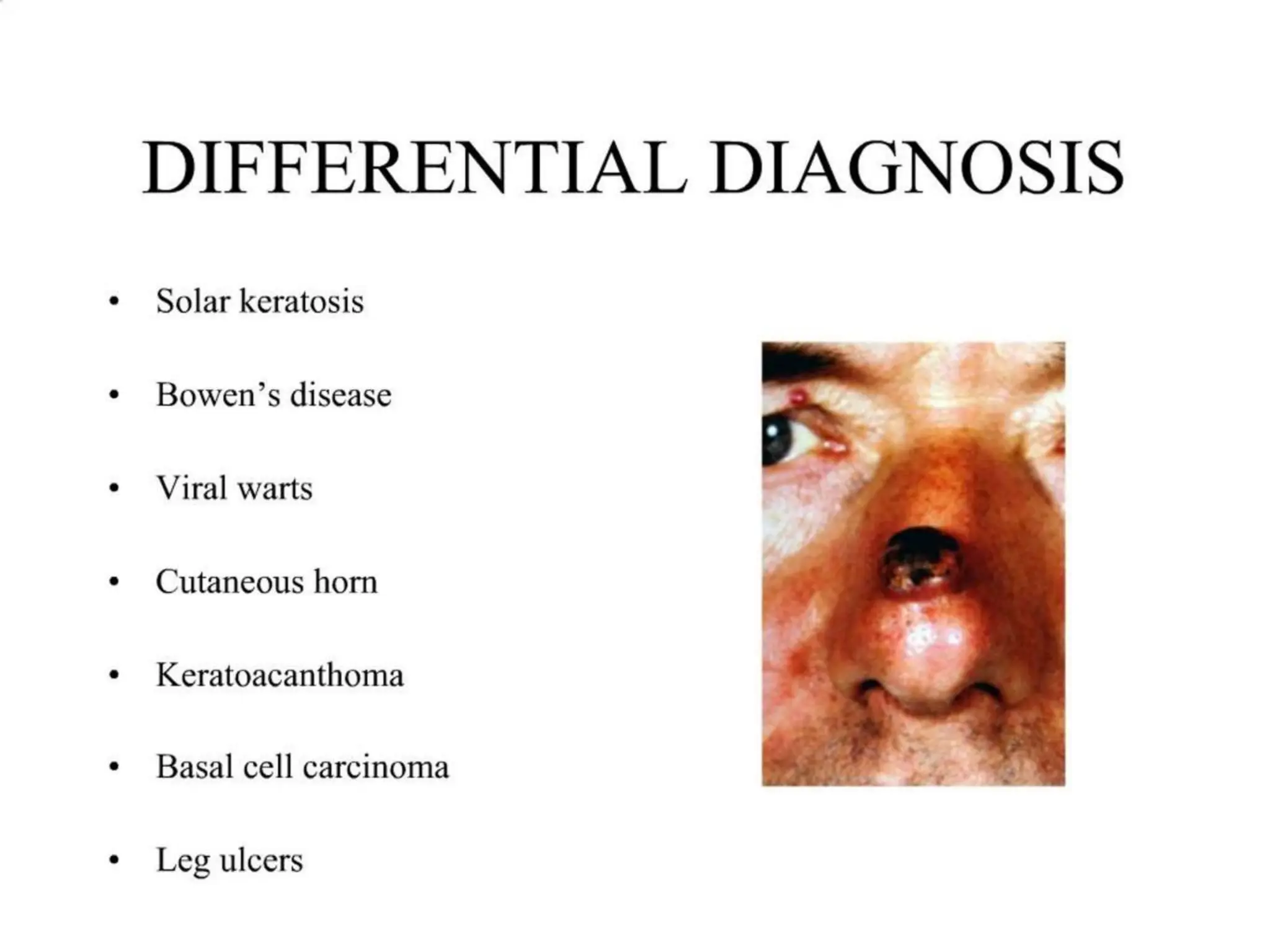 basal cell carcinoma 1807 cancer tumor marker tnm classification | PPTX