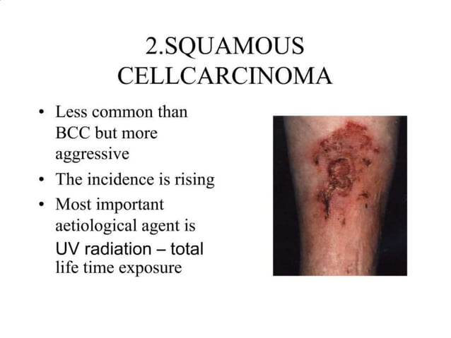 basal cell carcinoma 1807 cancer tumor marker tnm classification | PPTX
