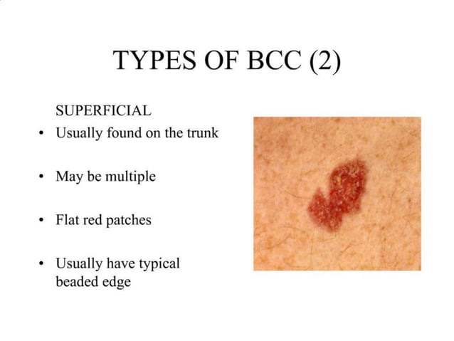 basal cell carcinoma 1807 cancer tumor marker tnm classification | PPTX