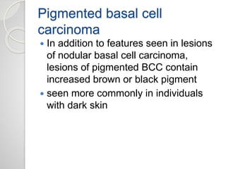 Basal cell carcinoma of oral cavity | PPTX