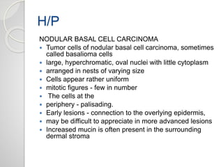 Basal cell carcinoma of oral cavity | PPTX