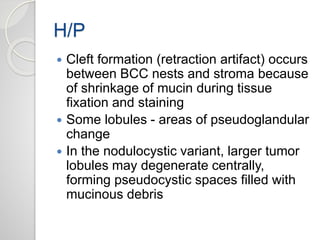 Basal cell carcinoma of oral cavity | PPTX
