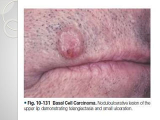 Basal cell carcinoma of oral cavity | PPTX