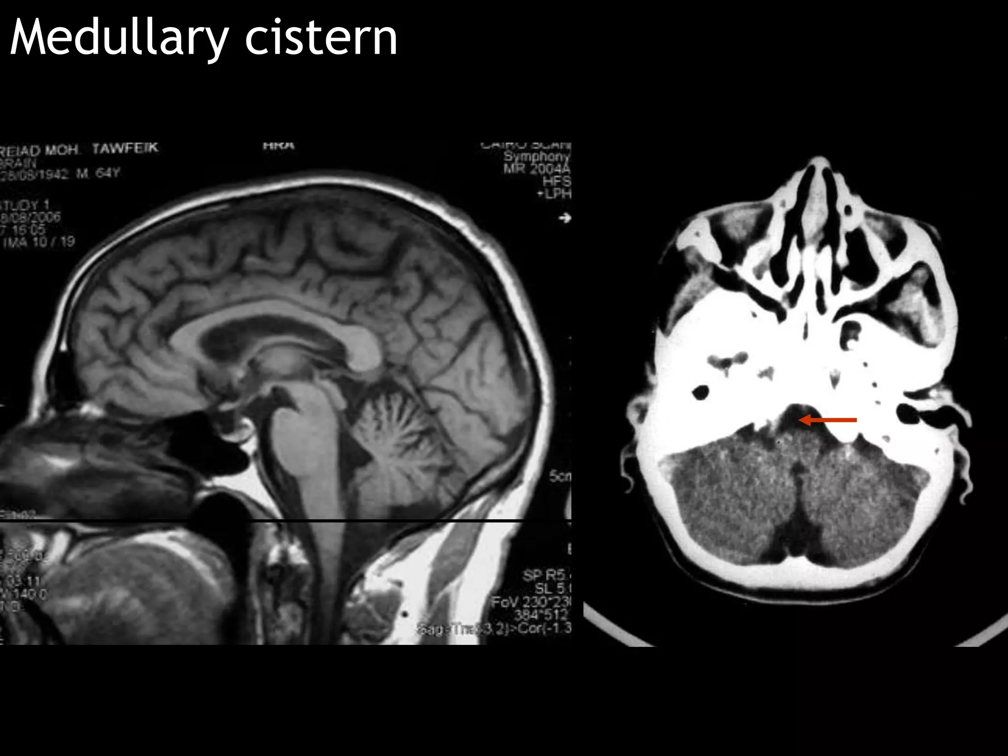 basal cisterns final.ppt
