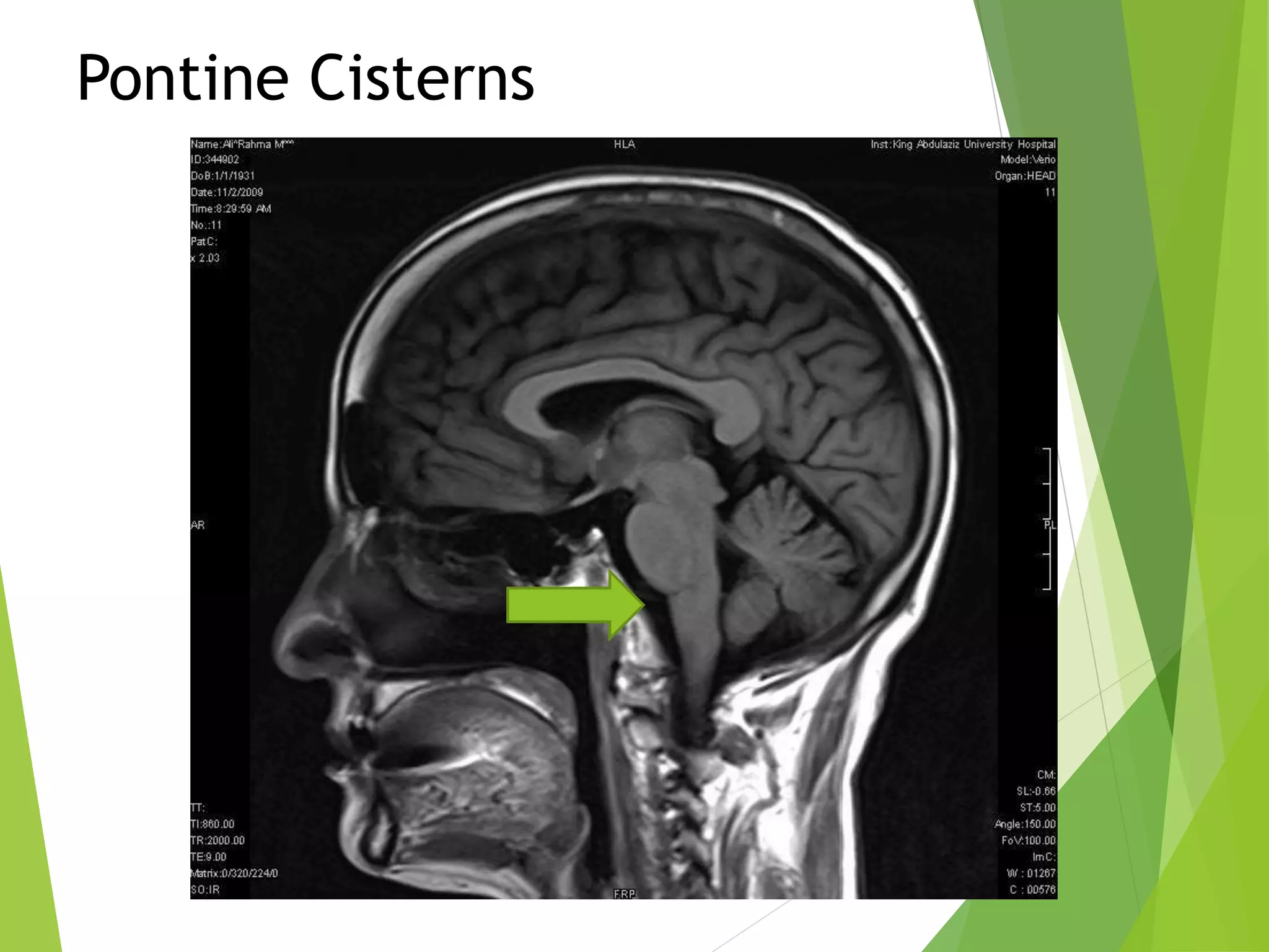 basal cisterns final.ppt