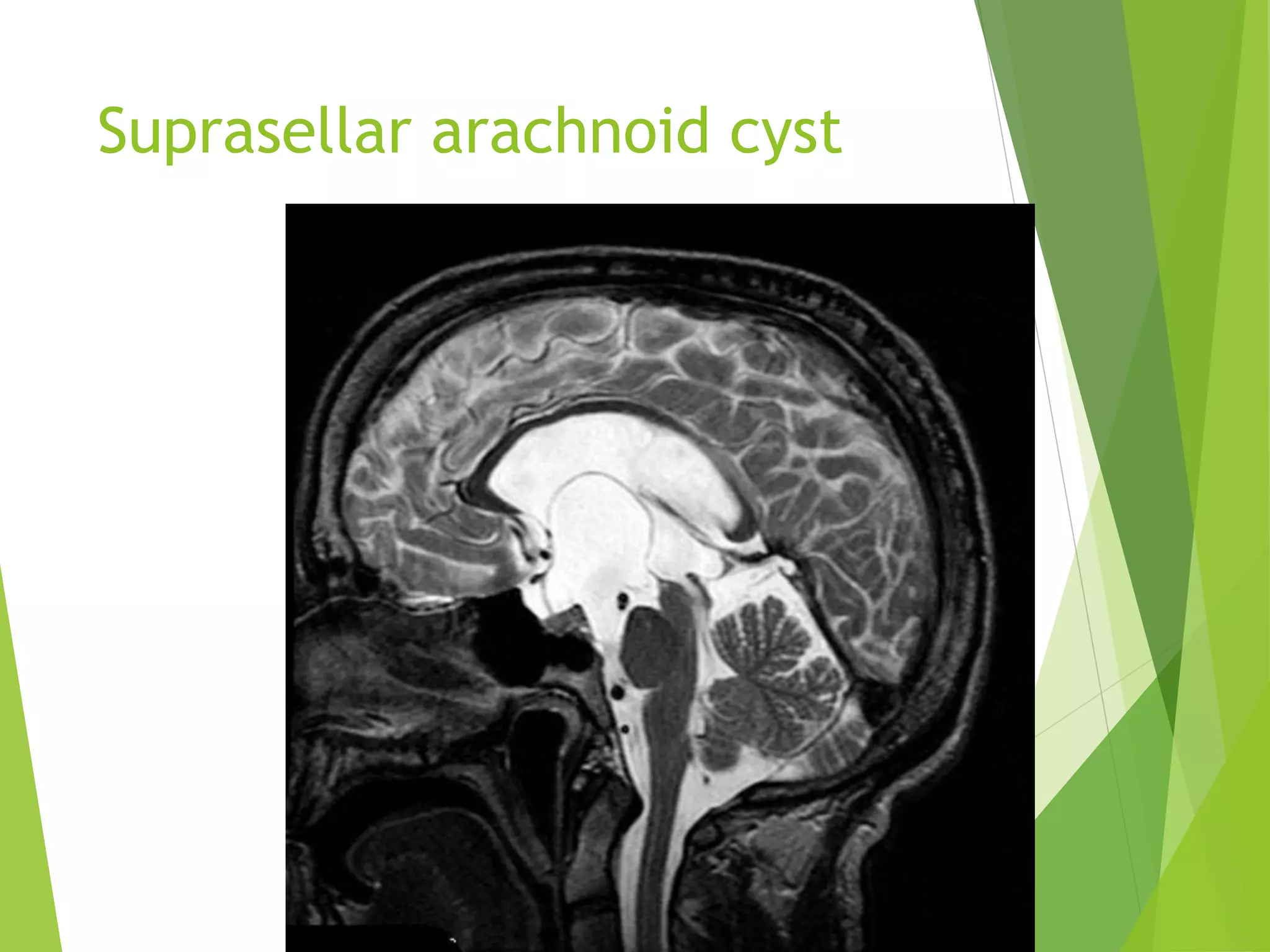basal cisterns final.ppt