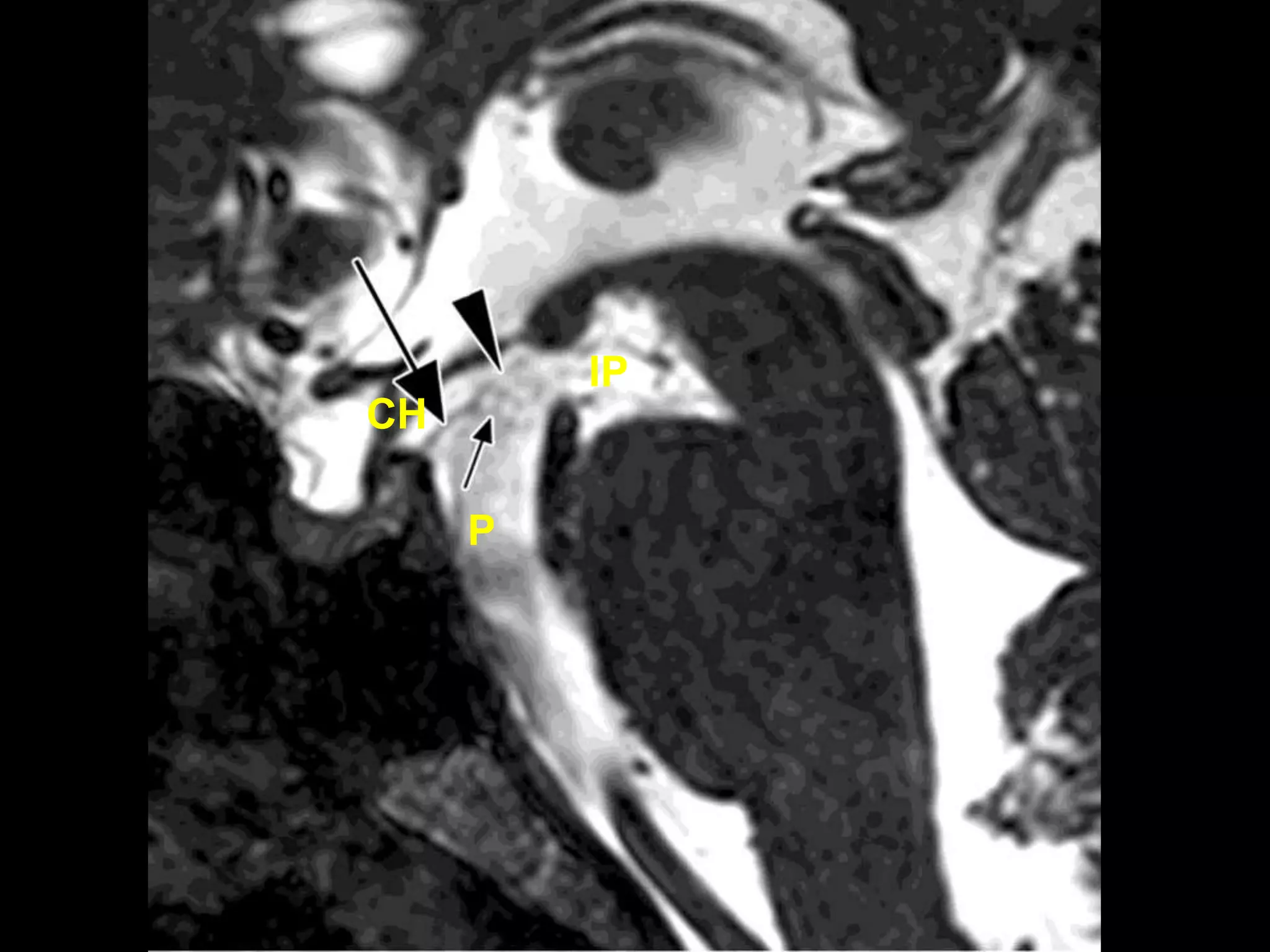 basal cisterns final.ppt