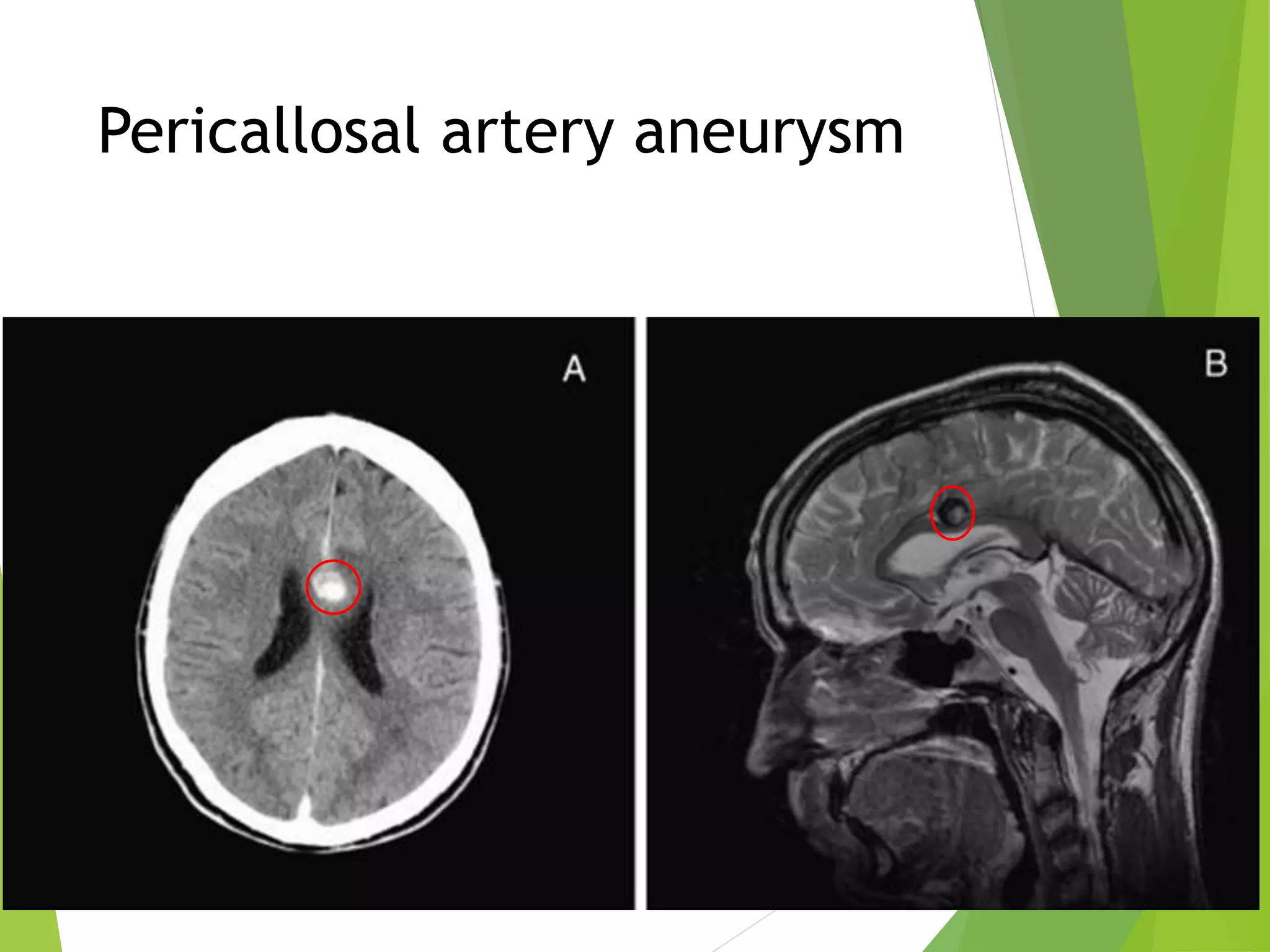 basal cisterns final.ppt