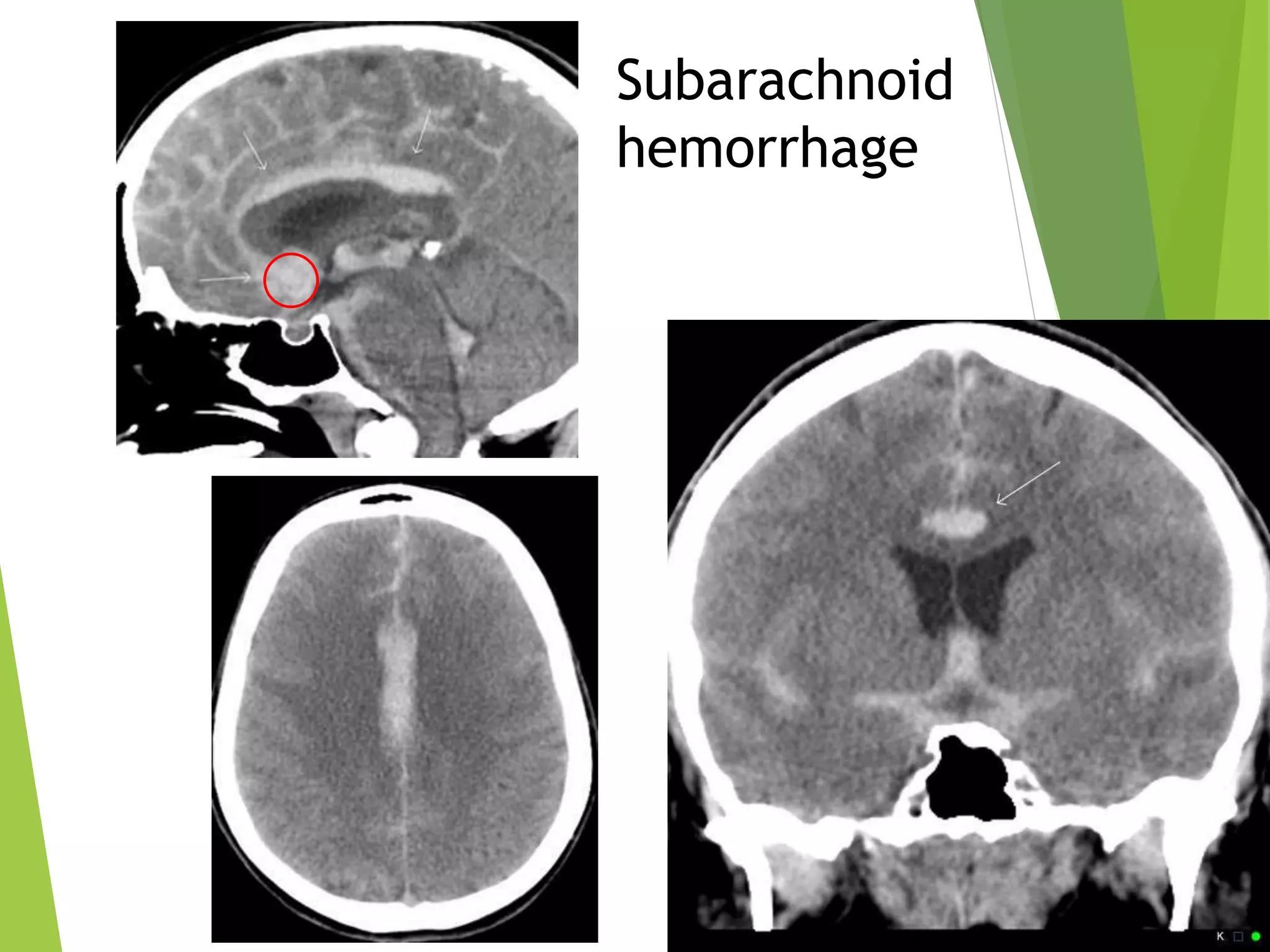 basal cisterns final.ppt