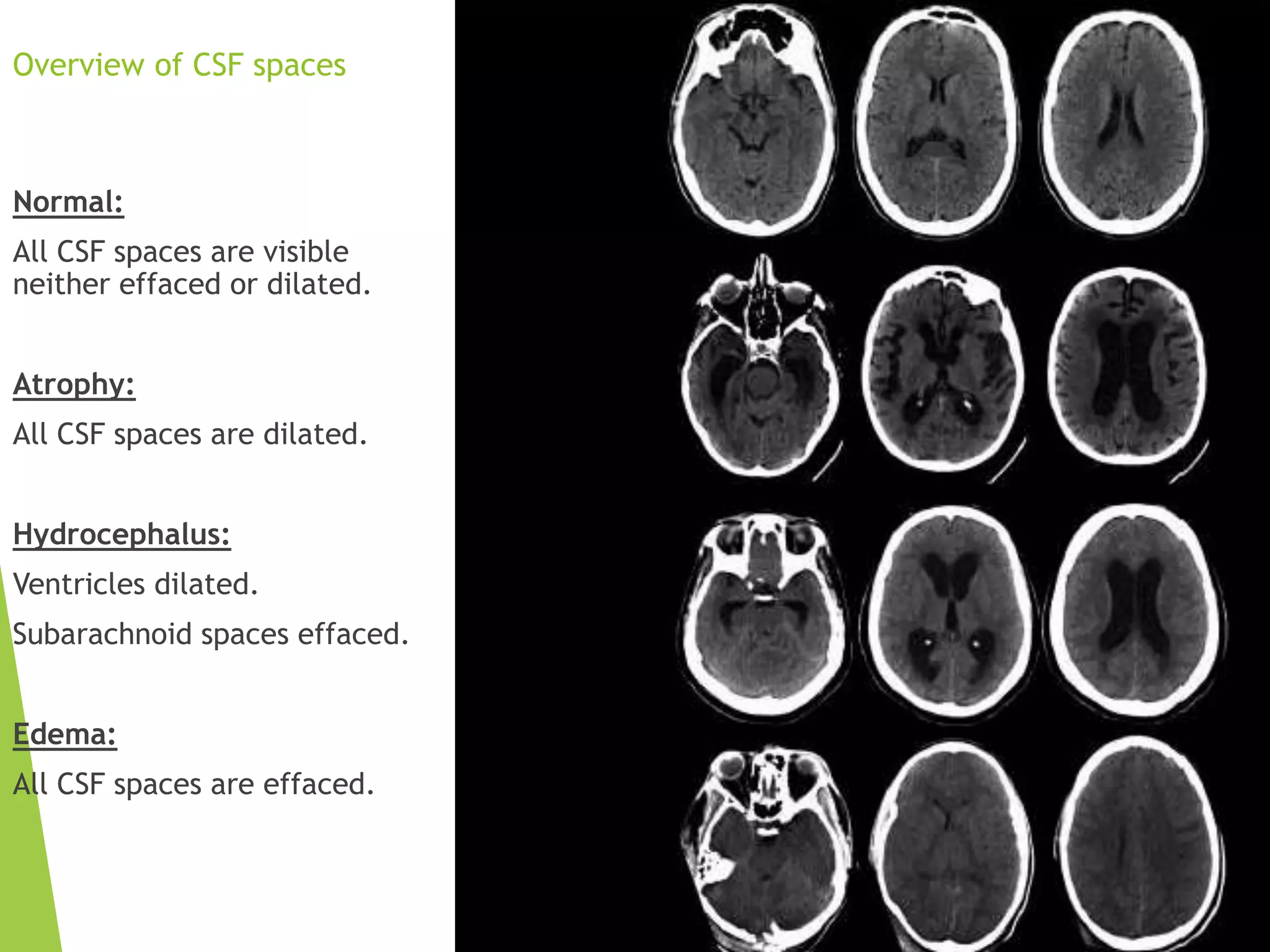 basal cisterns final.ppt