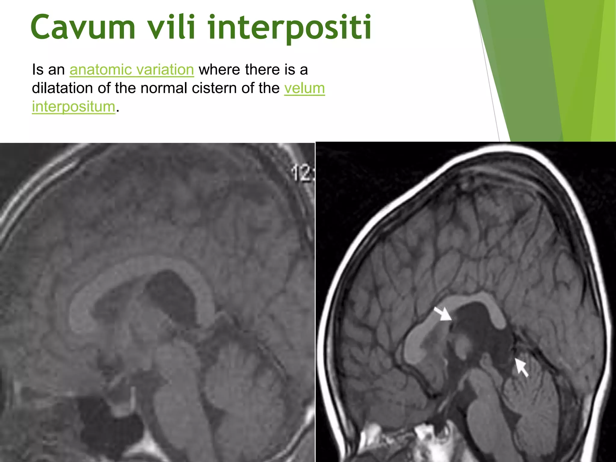 basal cisterns final.ppt