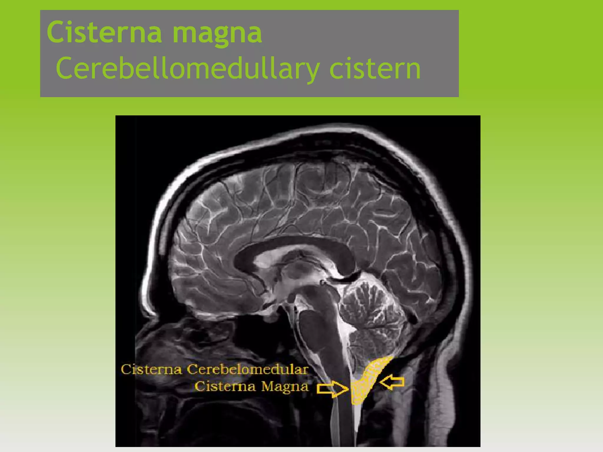 basal cisterns final.ppt