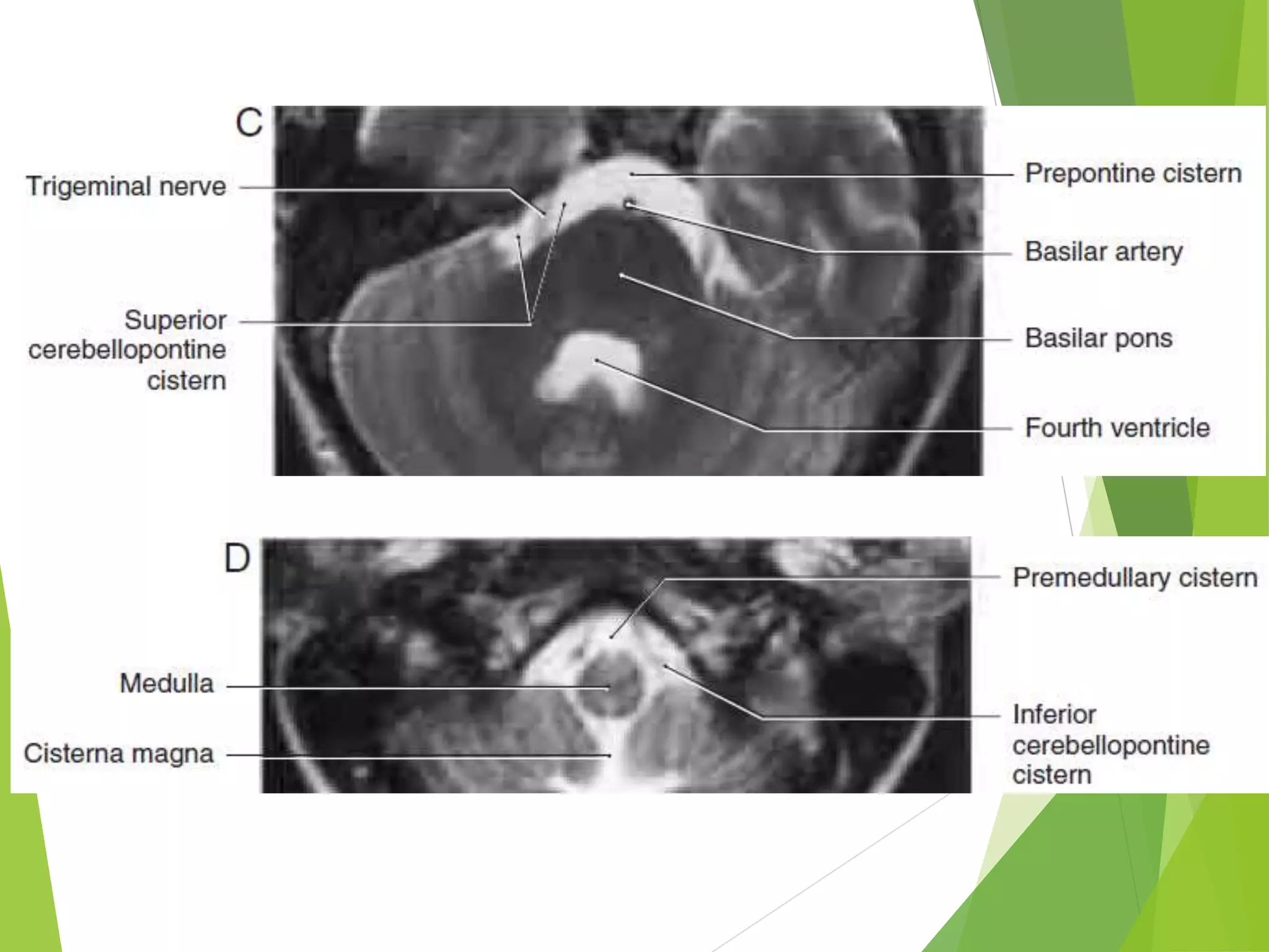 basal cisterns final.ppt