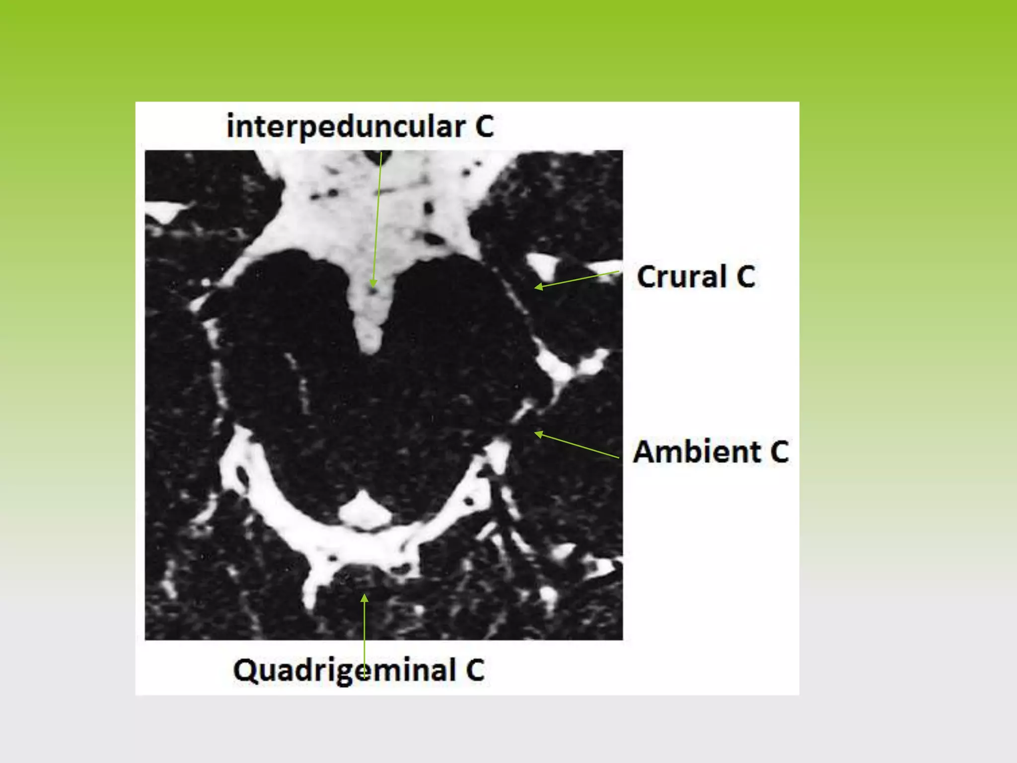 basal cisterns final.ppt