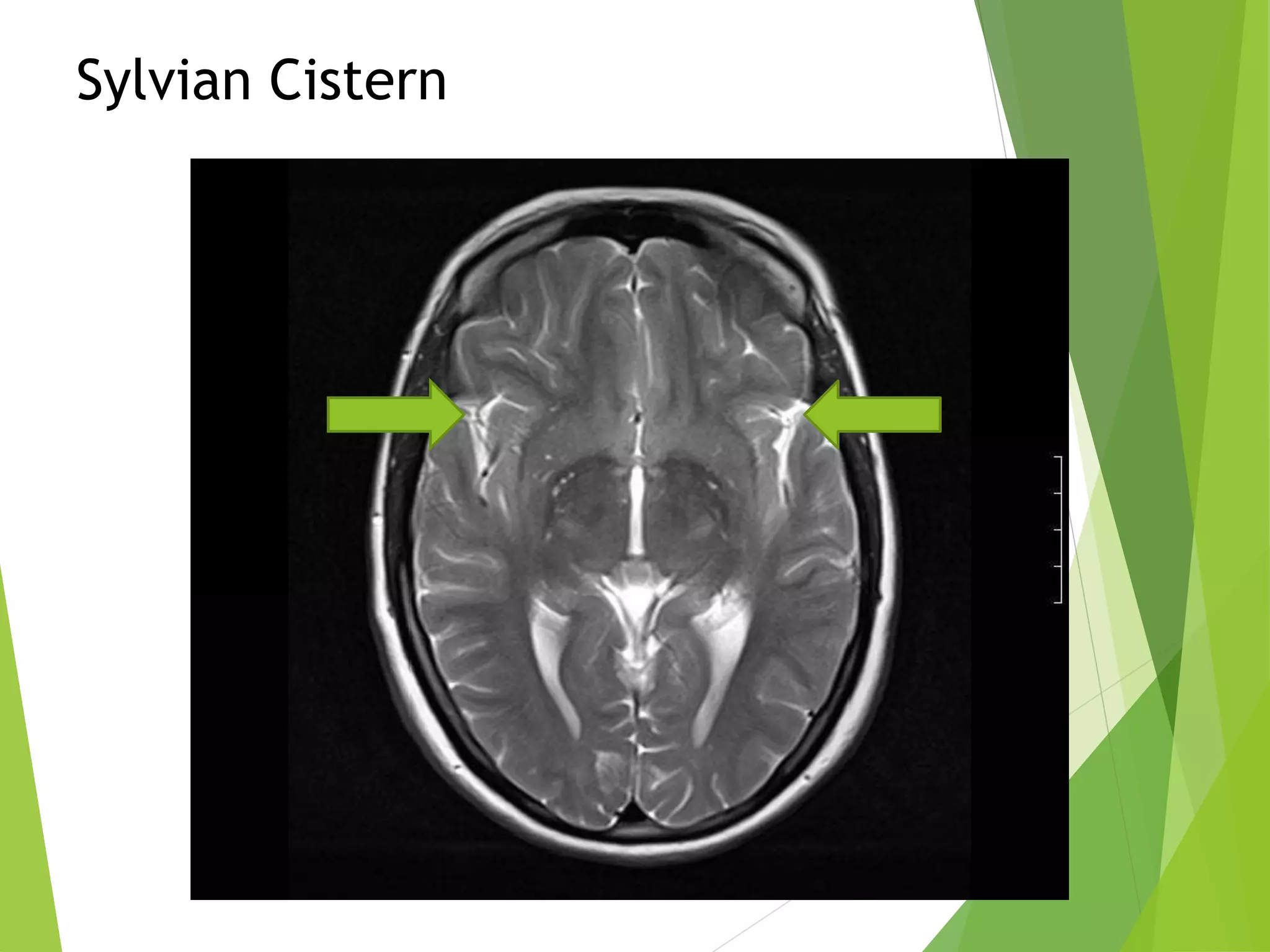 basal cisterns final.ppt