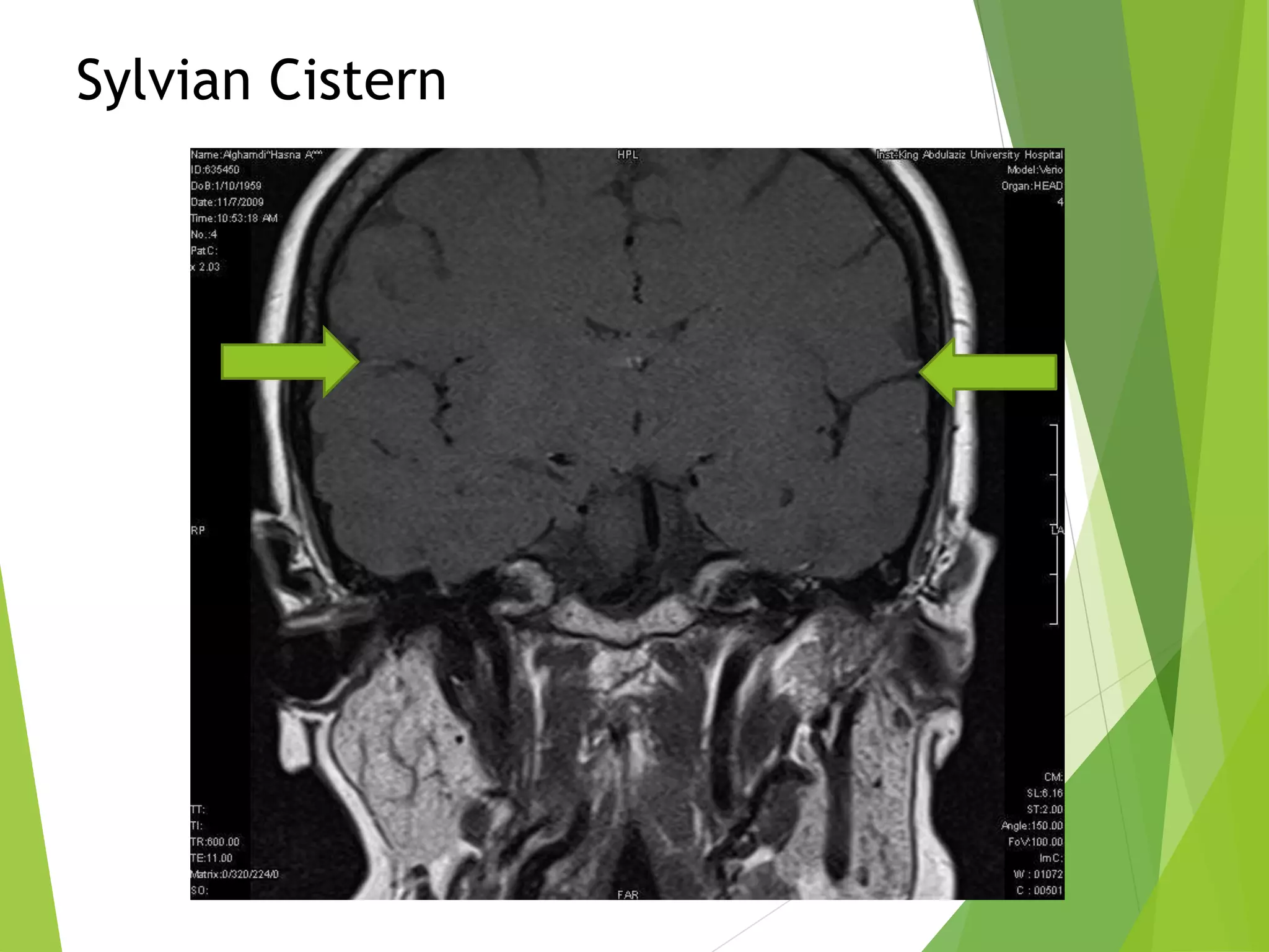 basal cisterns final.ppt