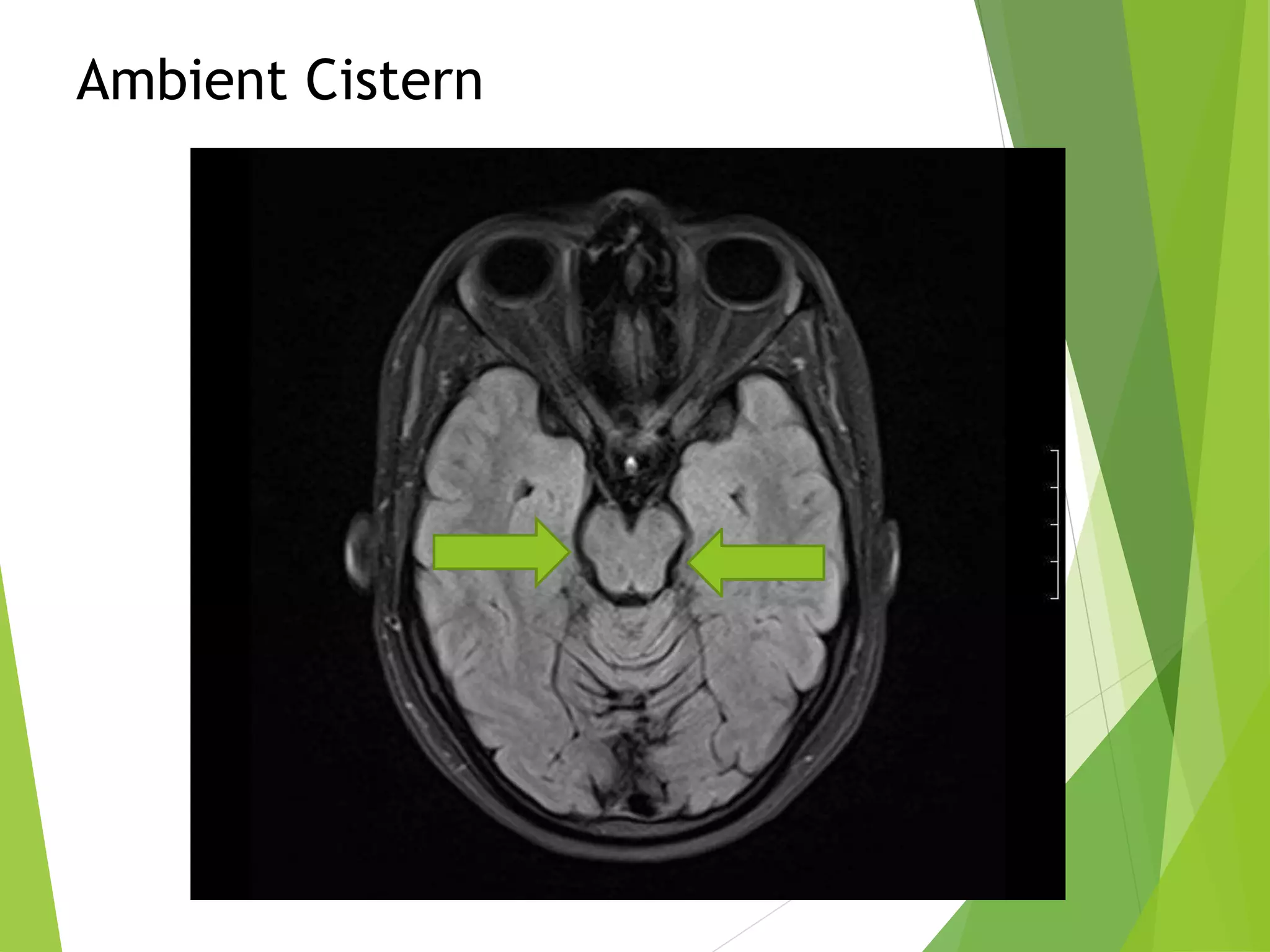 basal cisterns final.ppt