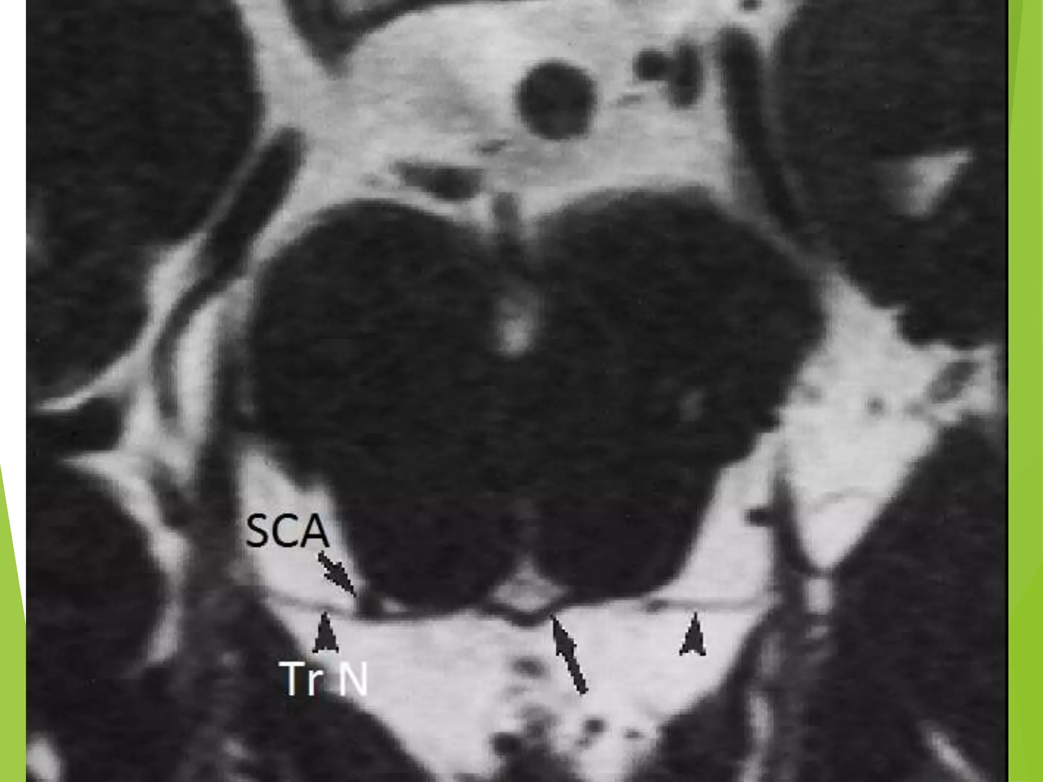 basal cisterns final.ppt