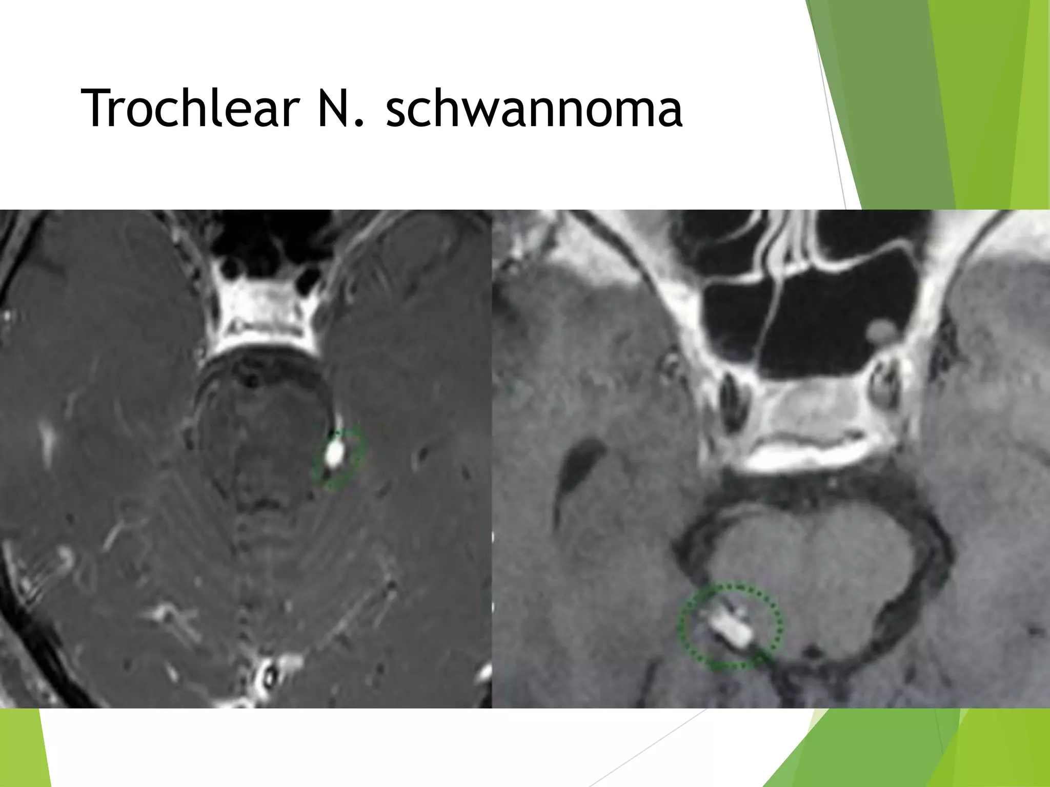 basal cisterns final.ppt